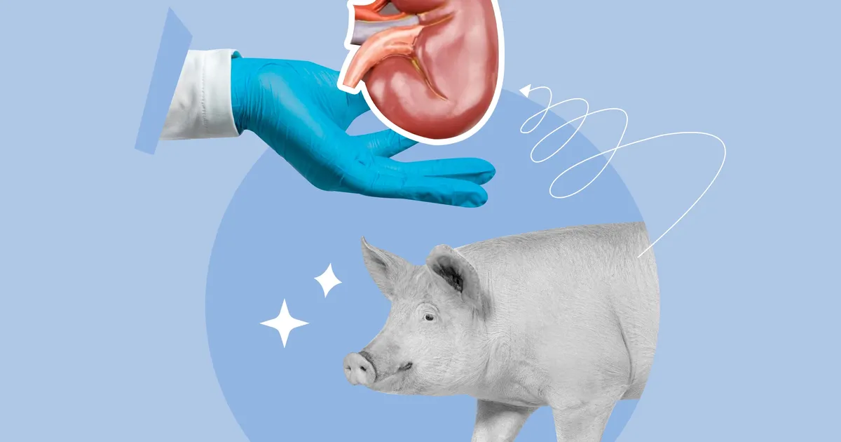 Suri inimene, kellele esimesena maailmas siirdati sea neerud