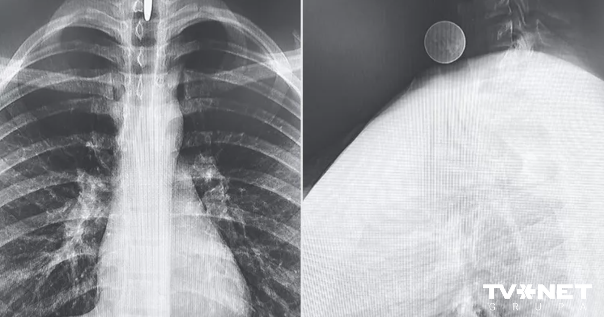 FOTO Pusaudzis, kuram rīklē iestrēgusi monēta, sūdzējies par "grūtībām ...