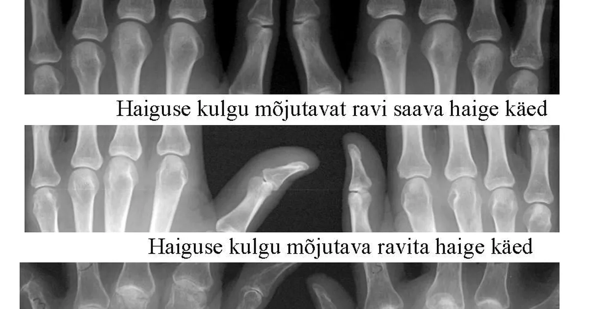 Tervis: Reumatoidartriit on levinumaid liigesehaigusi