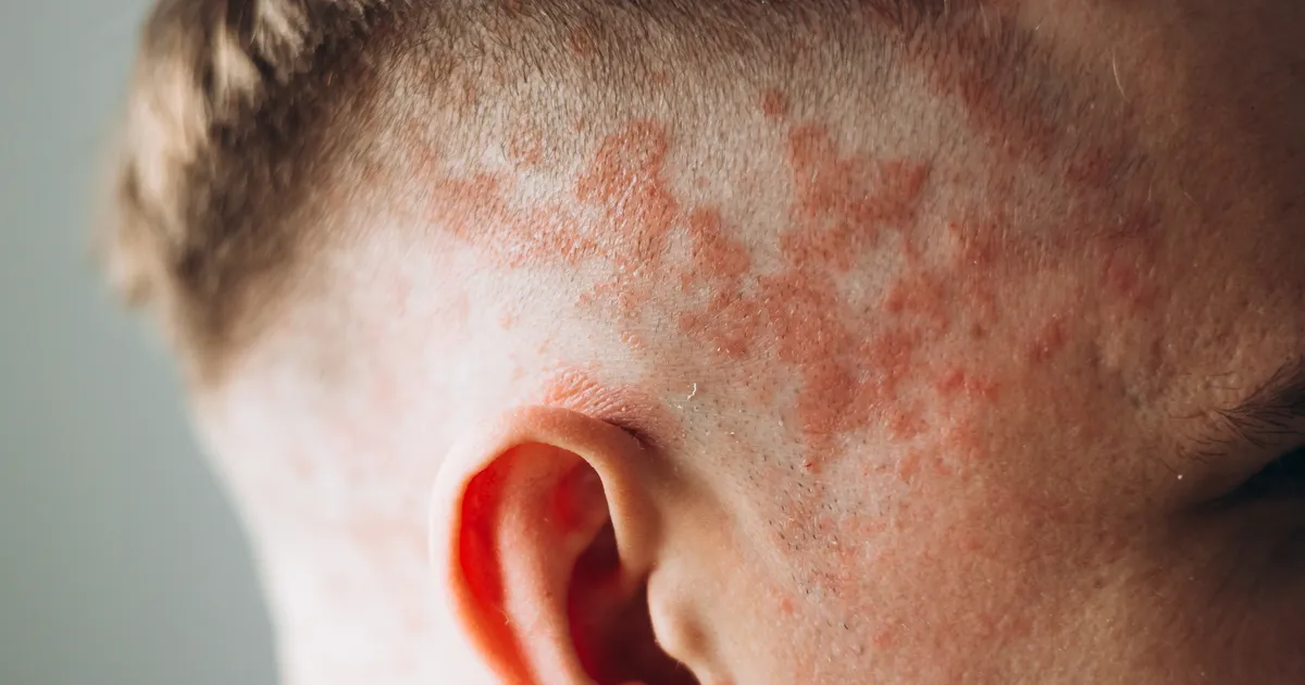 Taanis valmistati psoriaasi leevendav plaaster