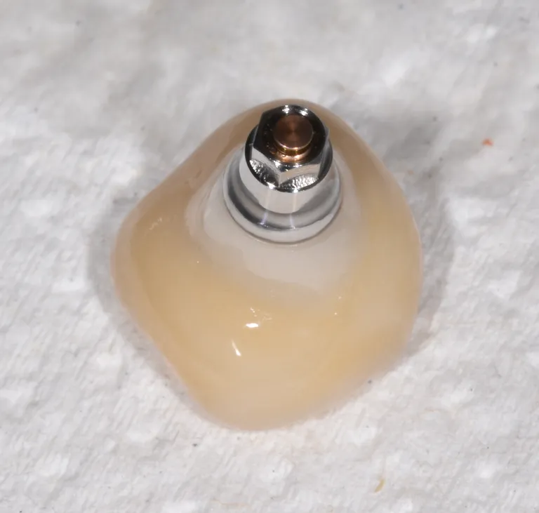 Pole vaja oodata: uus hammas eemaldamisega samal päeval