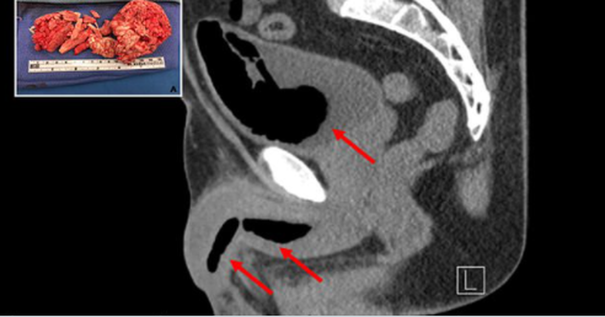 ARULAGE ÕNNETUS Impotendi partner muutis mehe peenise ...