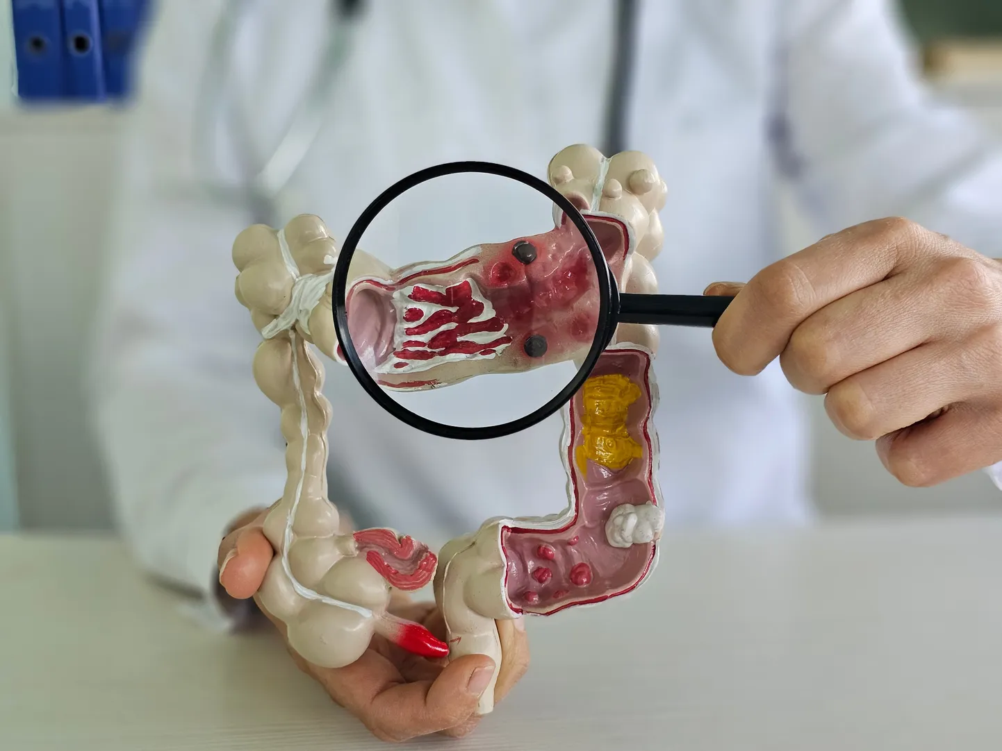 3 põhjust, miks peaks jämesoolevähi uuringuid tegema varem, kui on ...